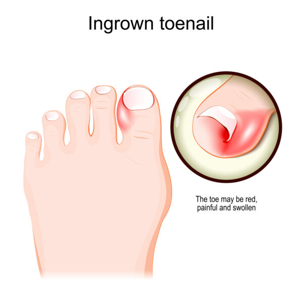 Ingrown Nails - Foot Ankle Restoration - Co Op City Podiatrist